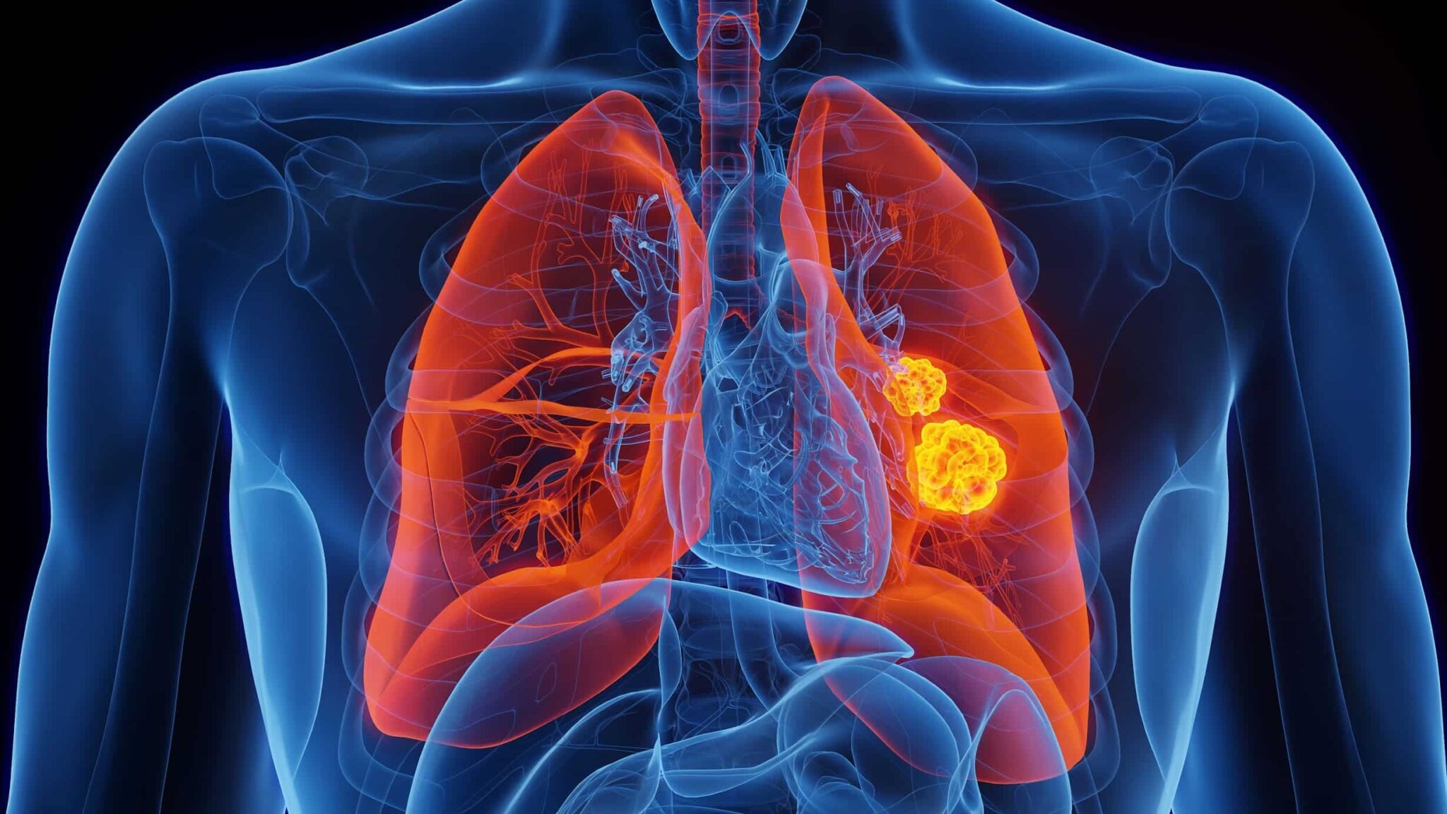 “El cáncer de pulmón es uno de los que produce más muertes en el Perú ...